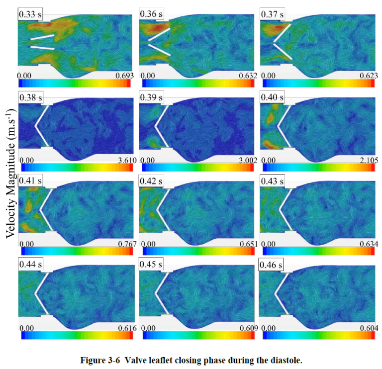 Saving Lives: CFD Simulation of a Mechanical Heart Valve - Simcenter